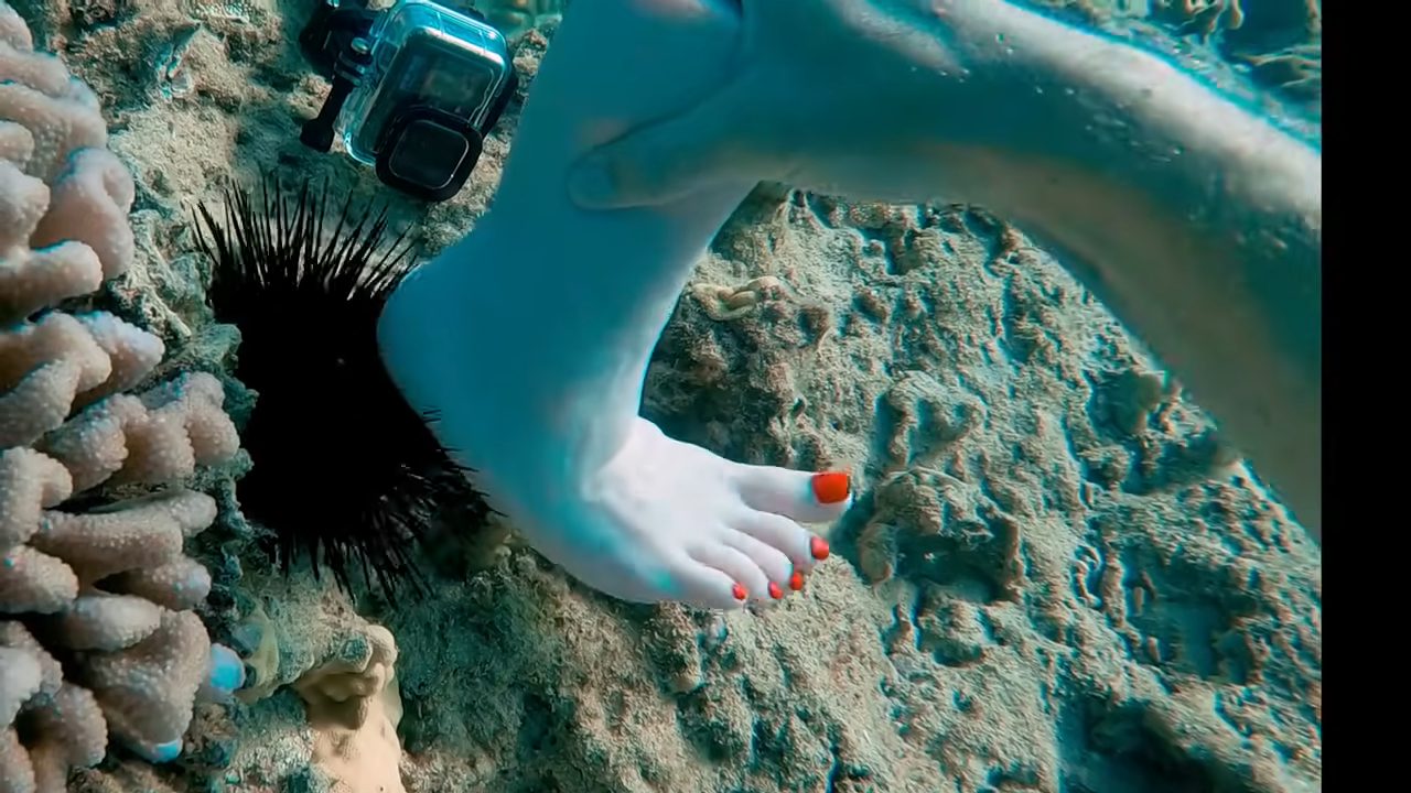 That's a sea urchin - then he stepped on it with a bare foot
