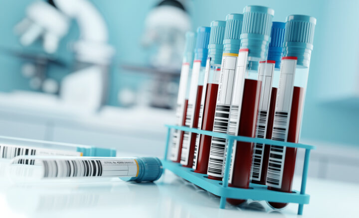 What cardiologists look at first in your blood test results