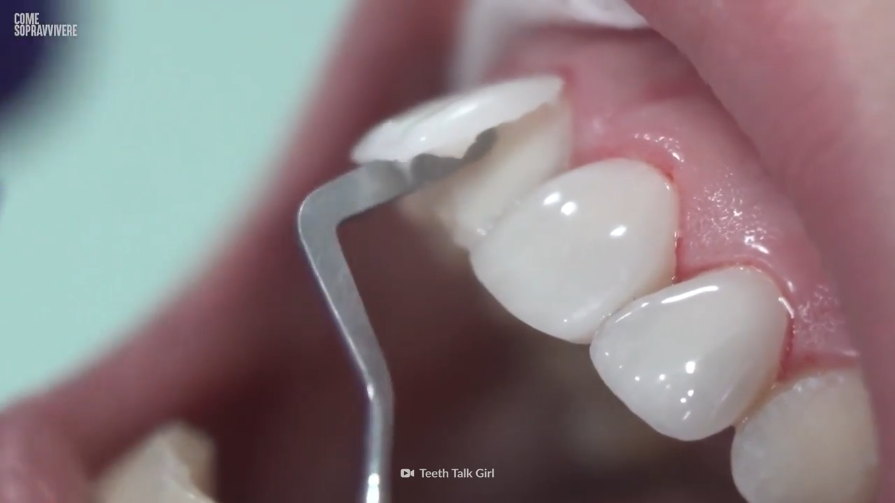 Si limano il 60% dei denti per un sorriso perfetto - poi pagano il prezzo