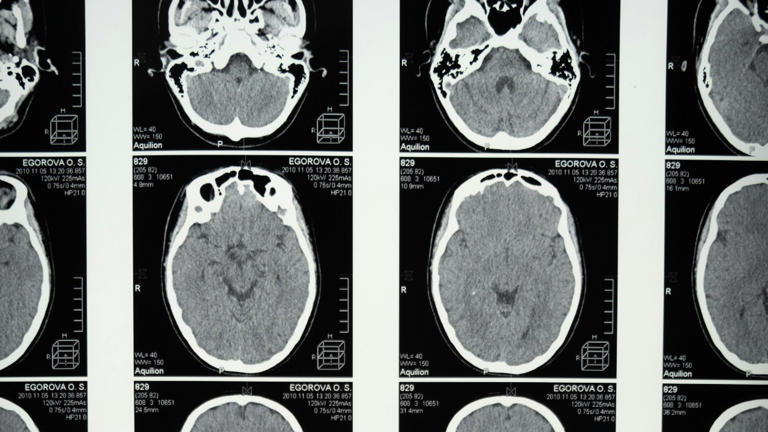 Study ties tinnitus to changes in a key brain chemical pathway