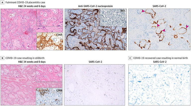 COVID-19 may leave placental damage, but virus disappears after ...