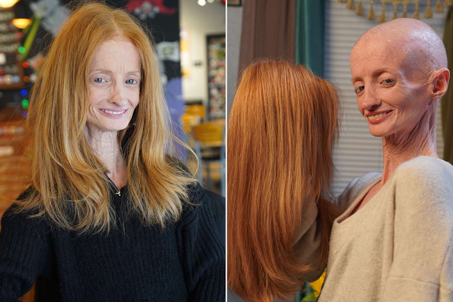 Woman with rapid-aging disease says she ‘knew I was different’ but didn ...