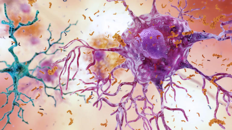 AI cracks the code on Alzheimer's greatest mystery