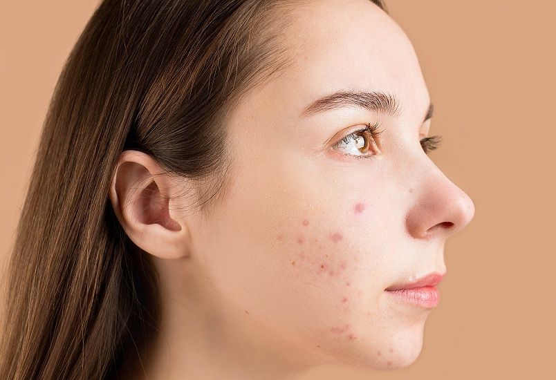 Bisa pakai madu, inilah 4 cara menghilangkan bruntusan di pipi secara alami