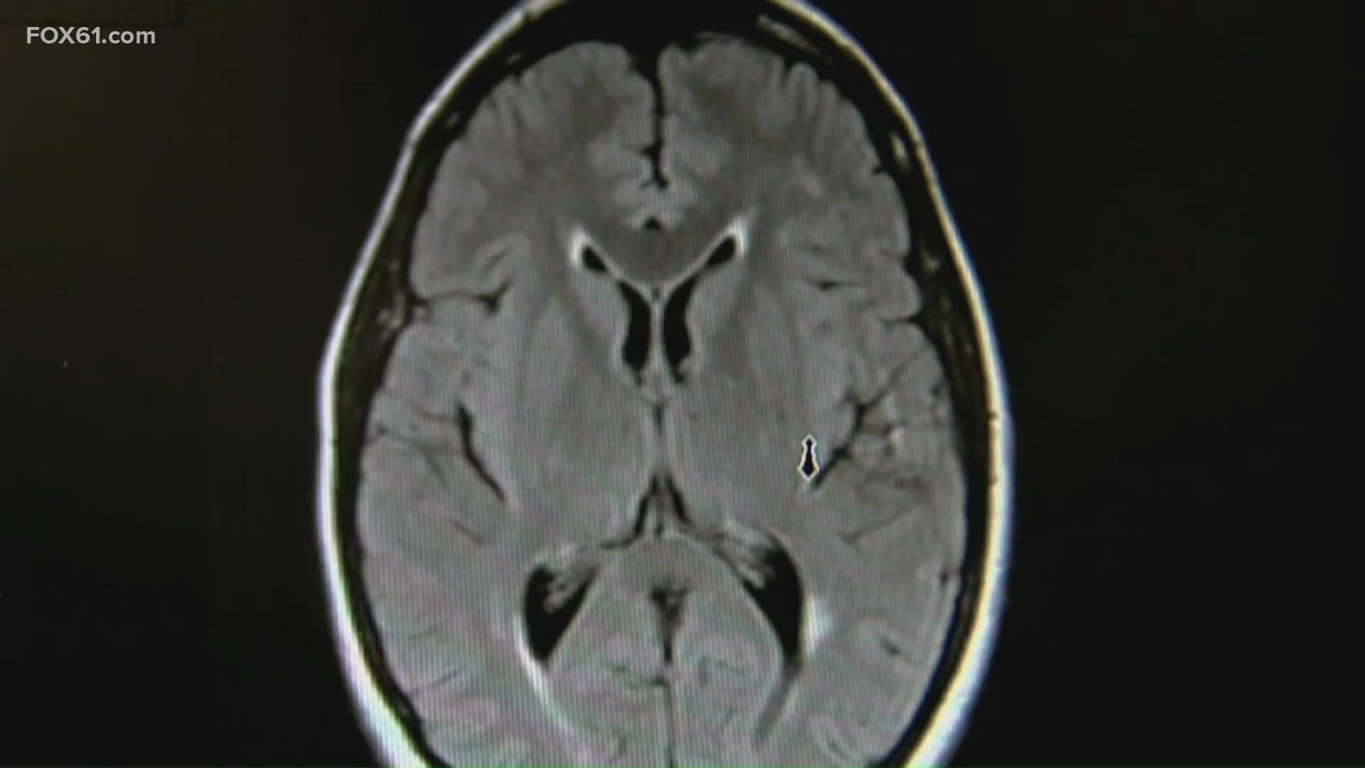 The latest Alzheimer's facts and figures