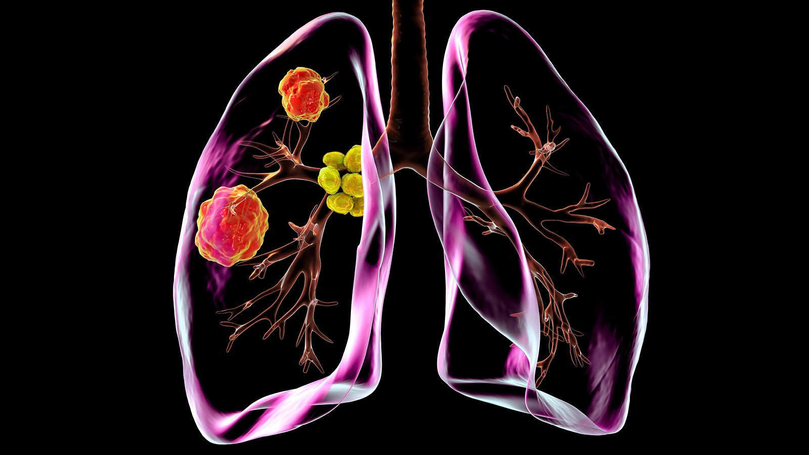 High rate of surgical success in complex NSCLC with neoadjuvant ...