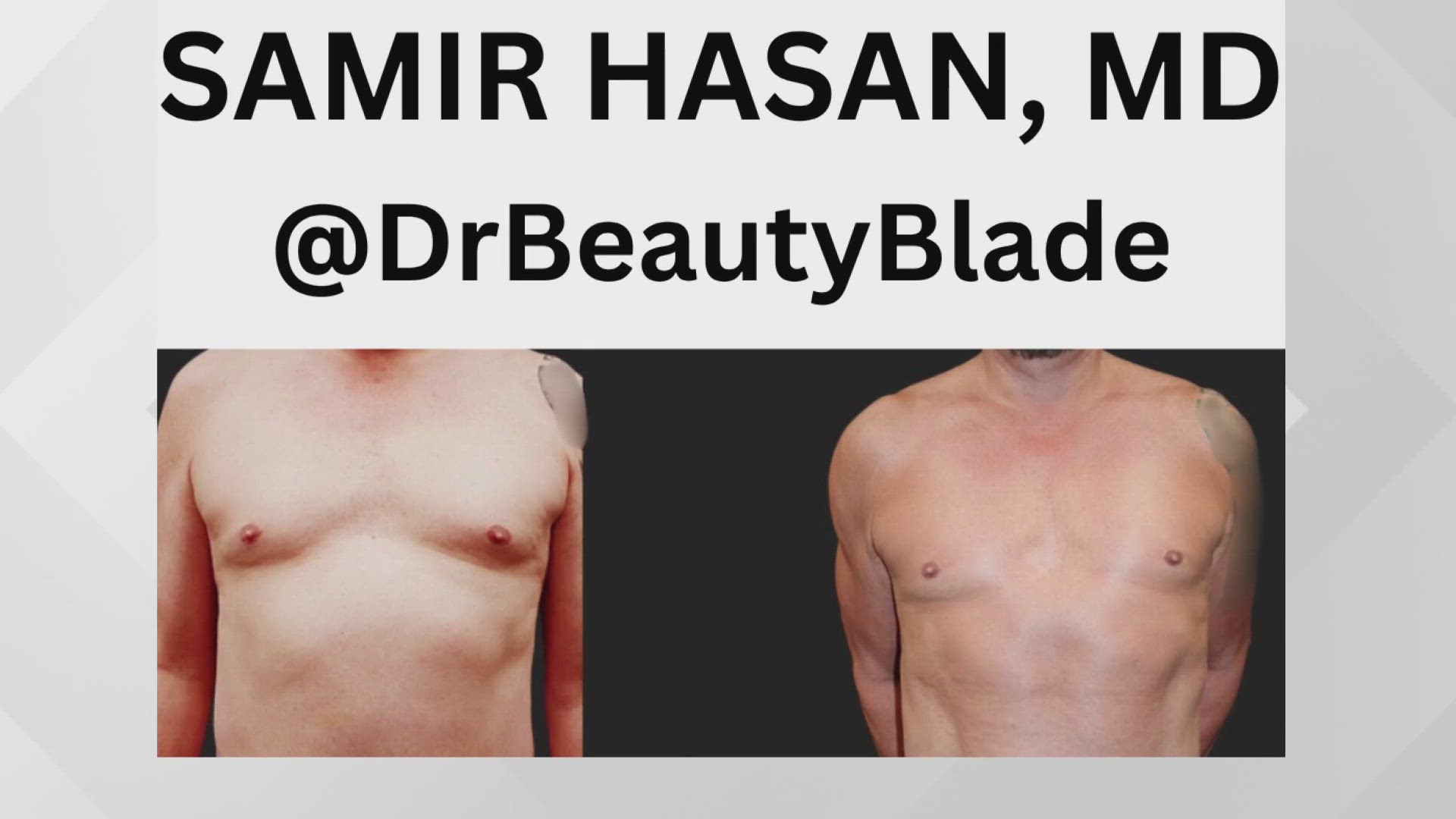 More men who are 'looks maxing' turning to cosmetic surgery