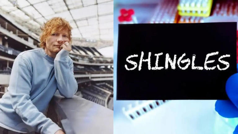 Ed Sheeran reveals painful shingles battle: A wake-up call on hidden risks