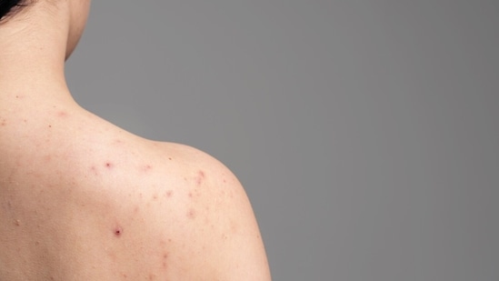 Body acne in summer? Dermatologist explains what you are doing wrong ...