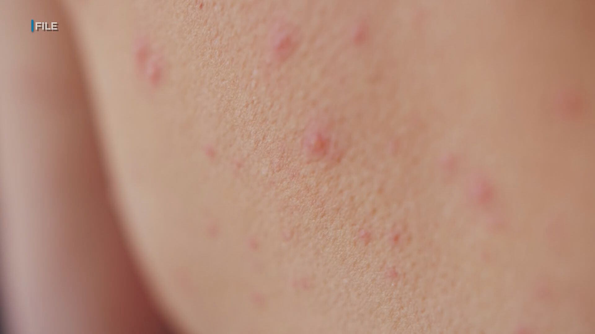 Six chickenpox cases confirmed in Sumner County, including two at ...