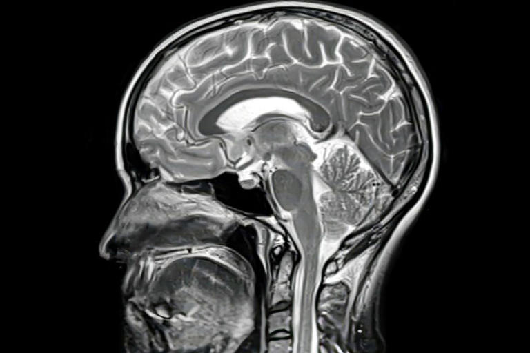 Popular supplement linked to slower brain repair raises dementia concerns