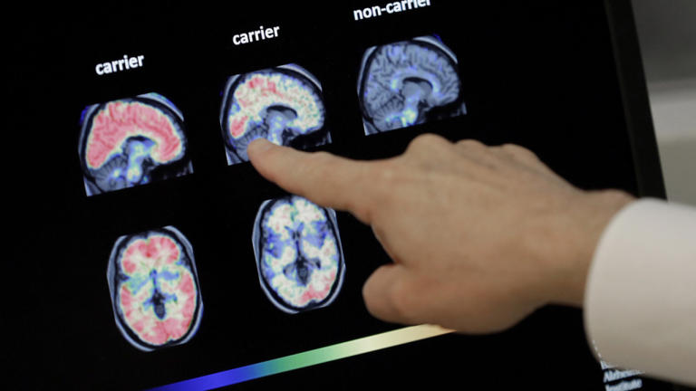 Νέες απεικονίσεις εγκεφάλου αποκαλύπτουν τρεις υποτύπους ΔΕΠΥ ...