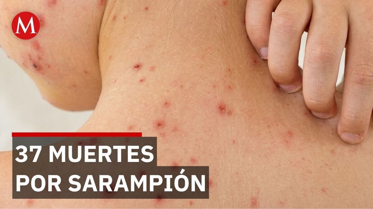 México enfrenta una crisis epidemiológica por sarampión en diversas ...