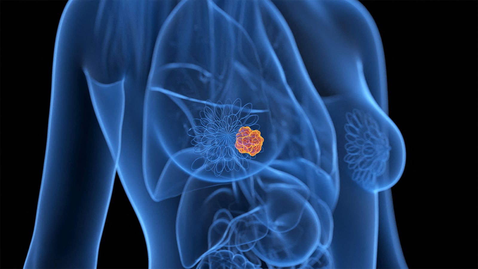 FDA panel gives thumbs down to novel strategy for switching breast ...