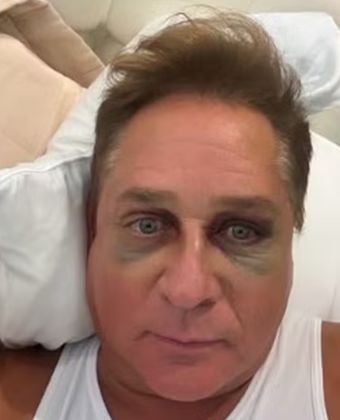 Mulher de Leonardo revela como está o cantor após acidente em pescaria