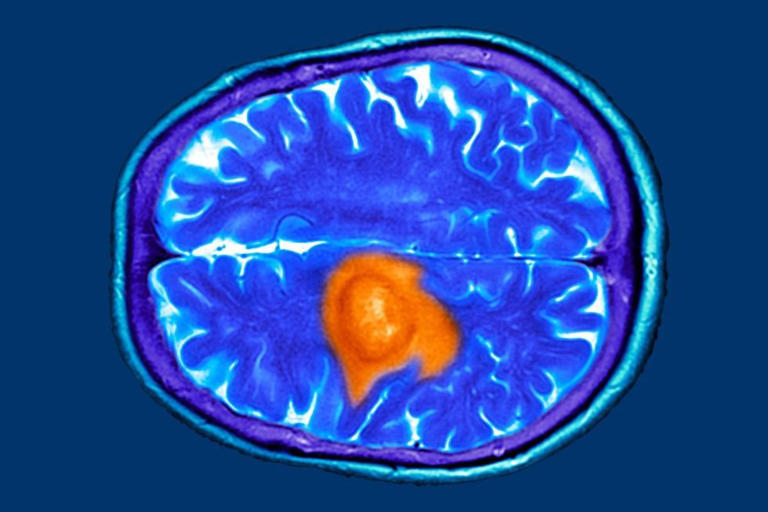 Stroke breakthrough may explain why treatments fail as scientists ...