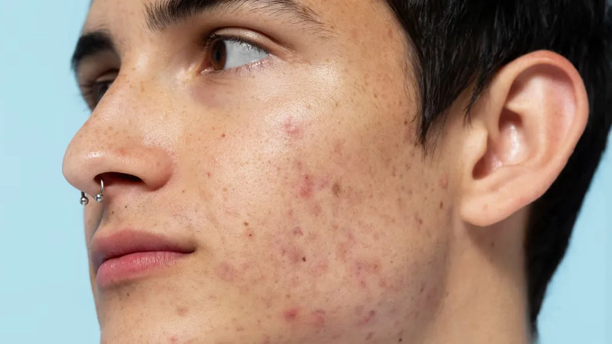 Rice water for acne-prone skin: Benefits, risks, and expert advice