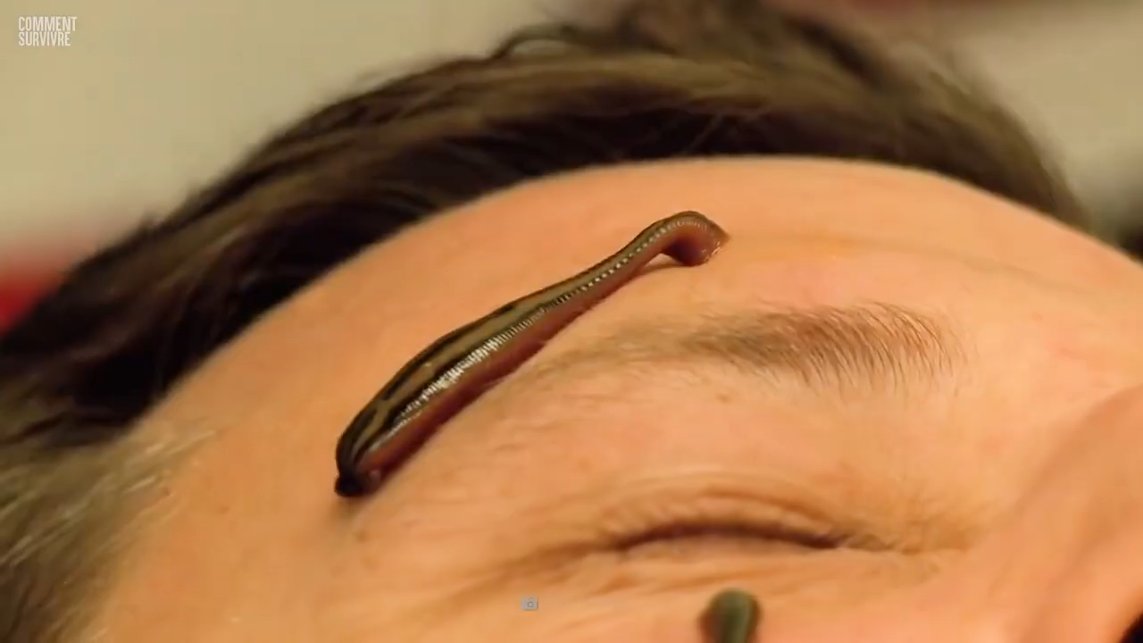 Ne lui arrachez surtout pas la peau - cette sangsue peut vous infecter
