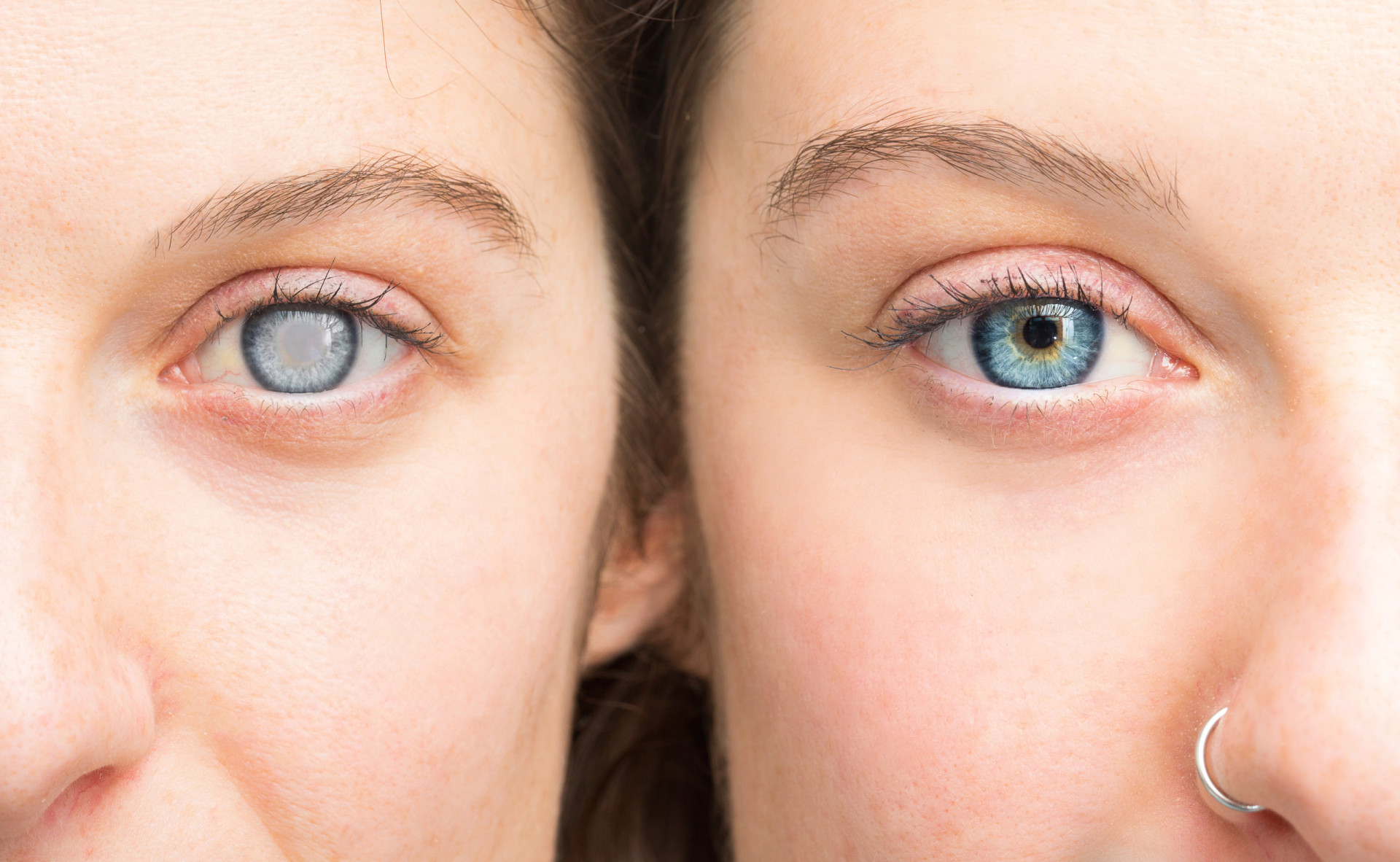 Retinitis pigmentosa: The eye disorder everyone should know about