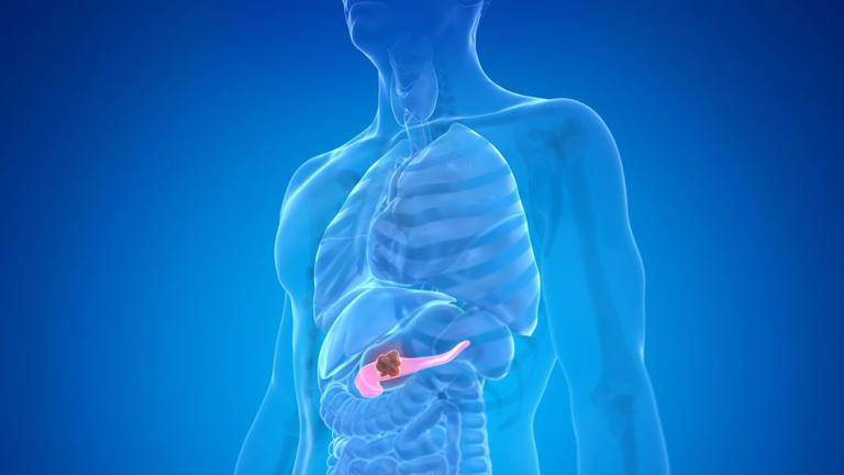 New AI model spots pancreatic cancer up to 3 years earlier than human ...