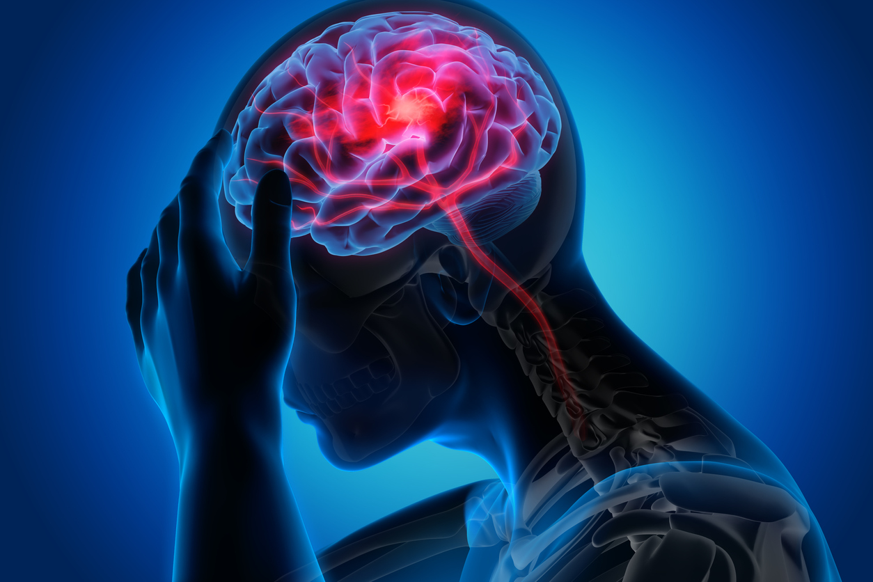 Kasus stroke sering jadi cacat permanen, kecepatan penanganan jadi kunci