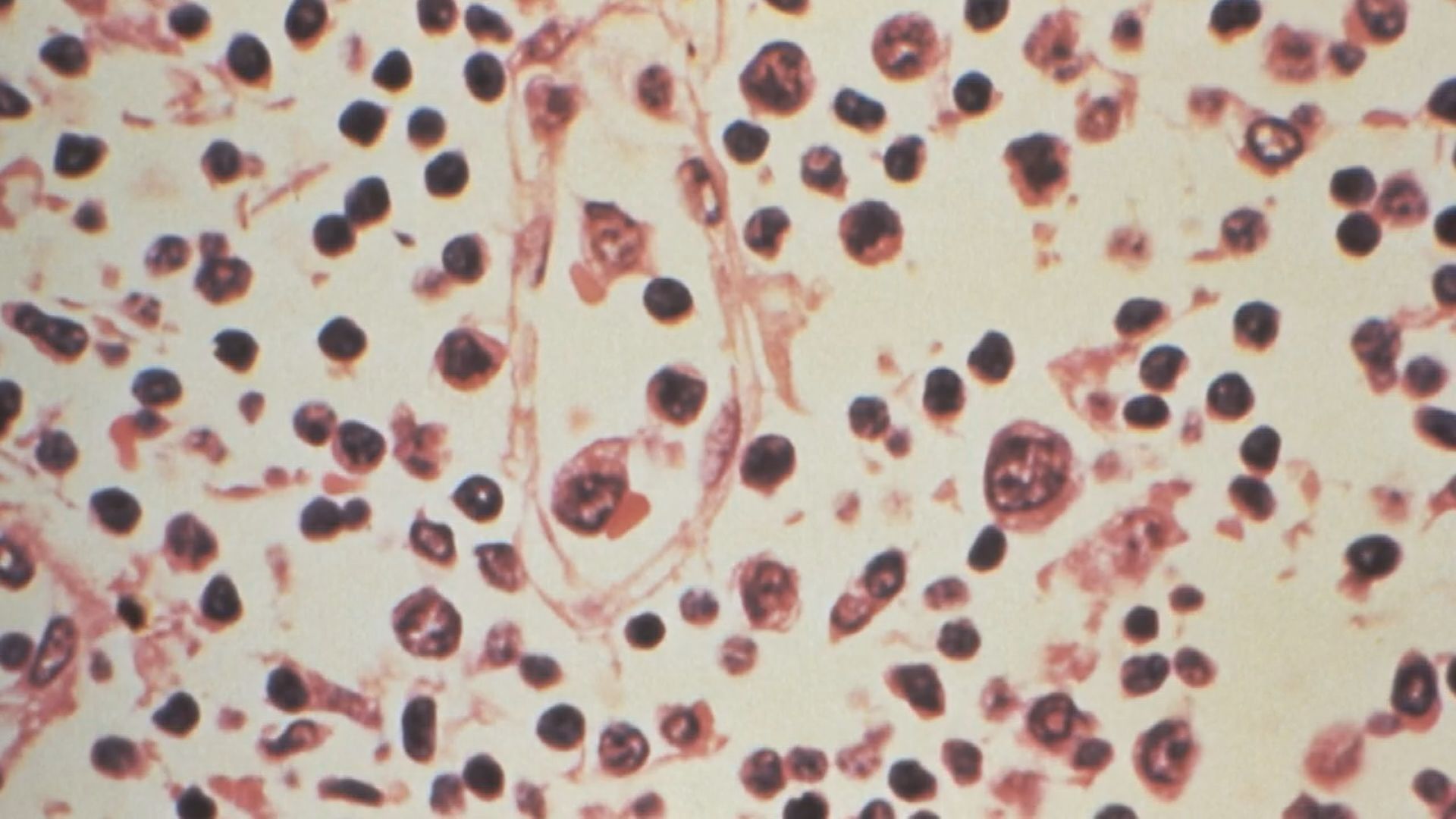 Hantavirus: What to know about the Andes strain