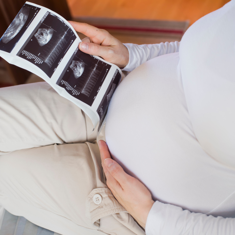 El impacto del embarazo en el lipedema: Síntomas y cómo tratarlo