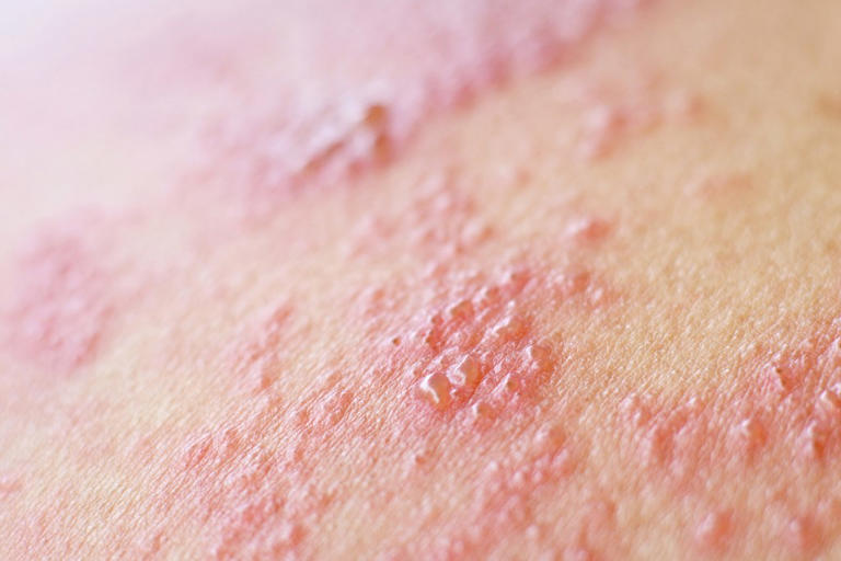 Outbreak of horrific skin-eating disease at California school