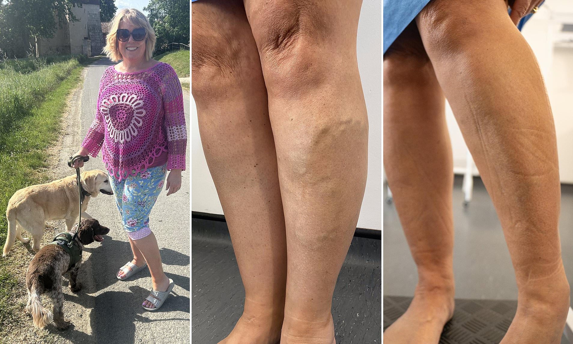 Woman, 54, shows off incredible results after removing 'blue snake ...