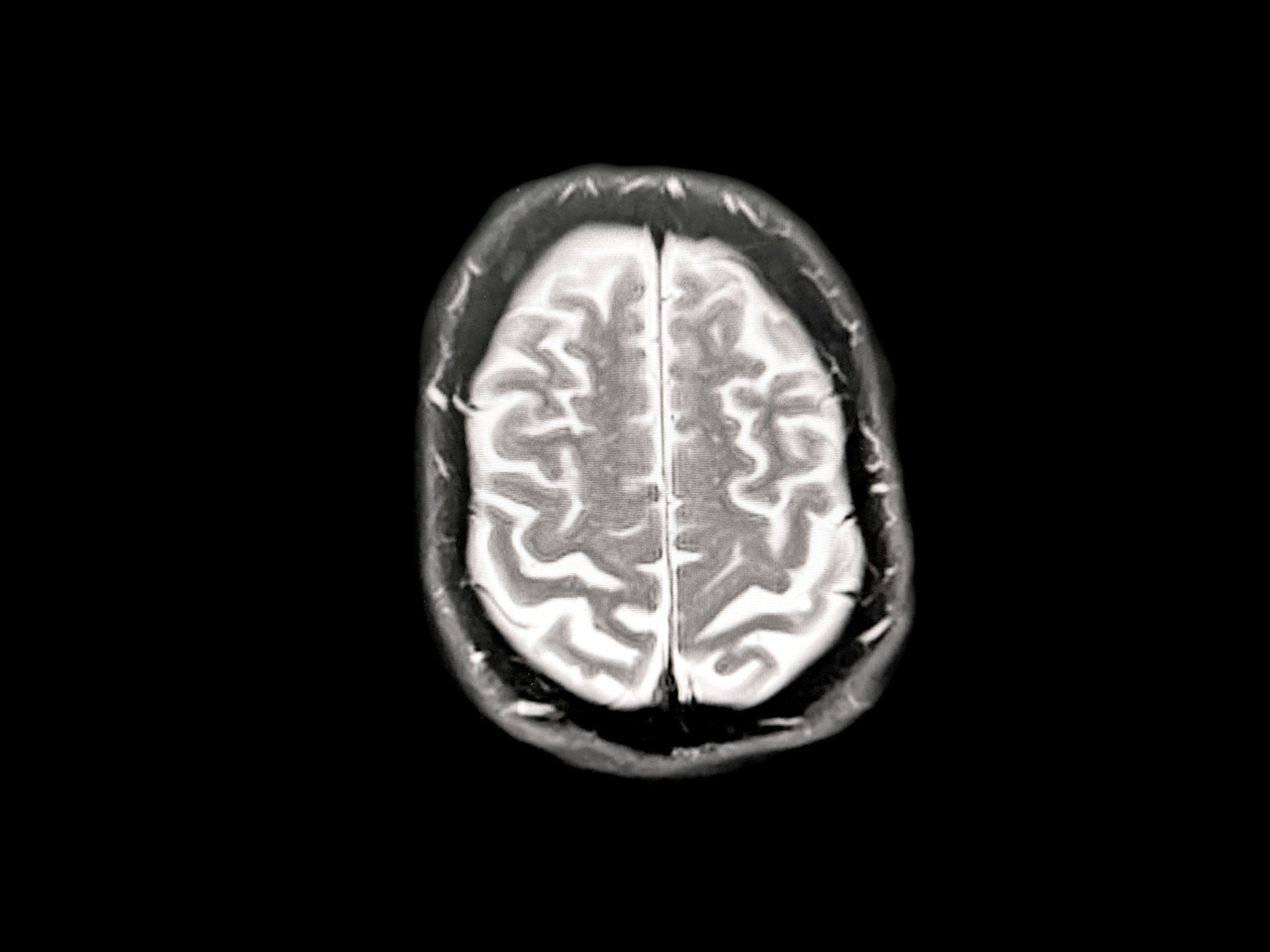 The rare disorder that makes people see demon-like faces