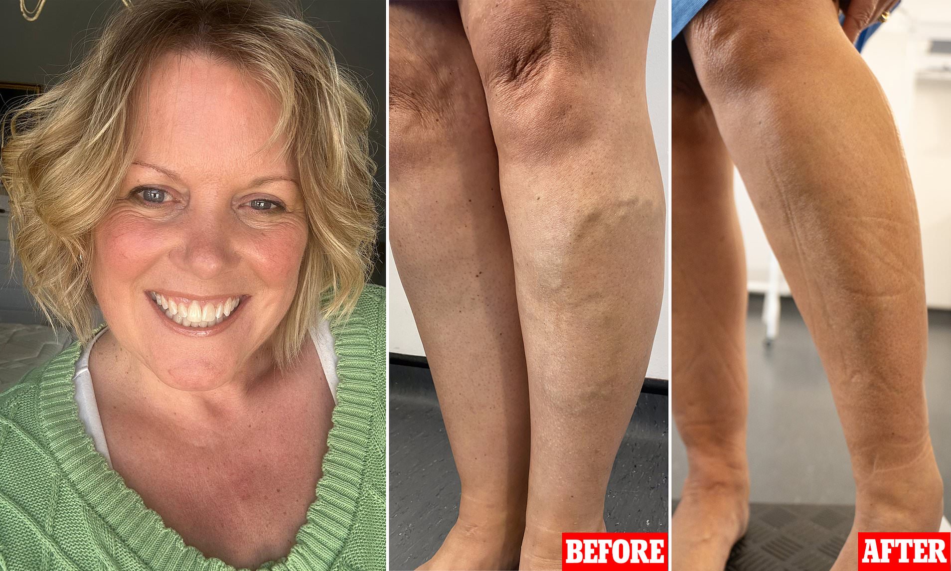 Woman, 54, shows off incredible results after removing 'blue snake ...