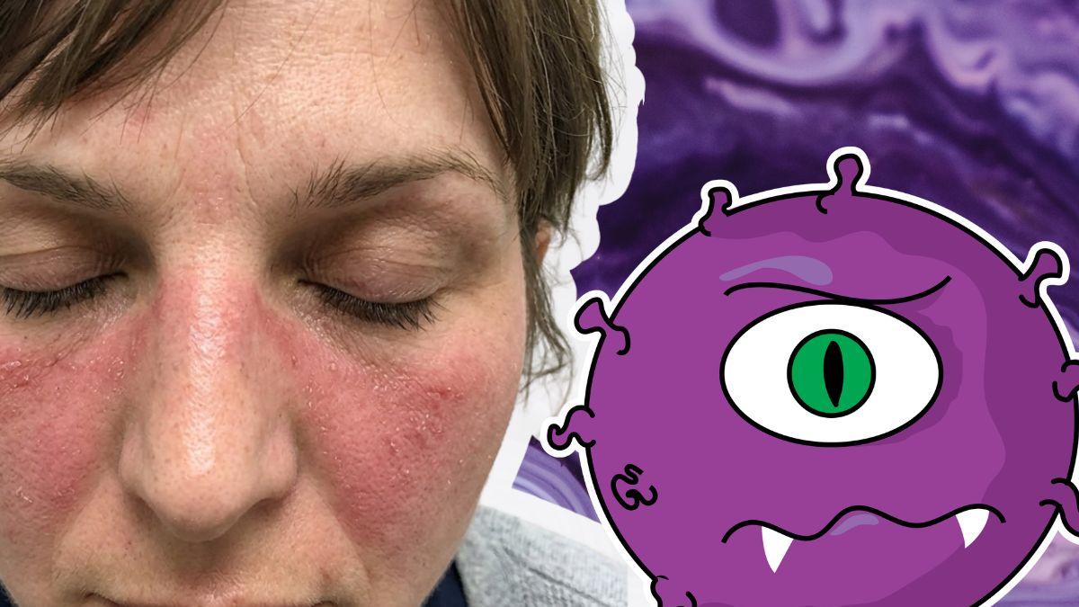 ¿Por qué el lupus afecta más a las mujeres y cómo detectarlo?