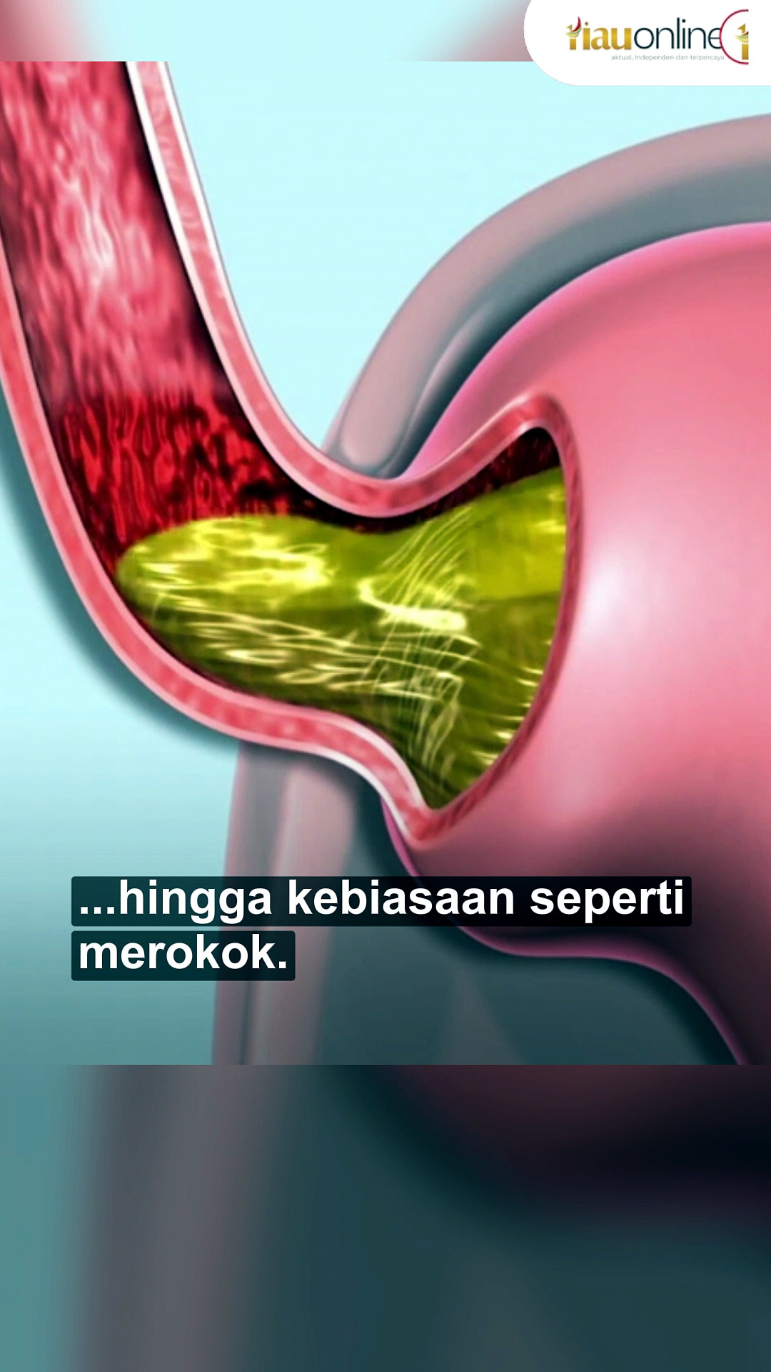 13 makanan berbahaya untuk penderita GERD dan asam lambung