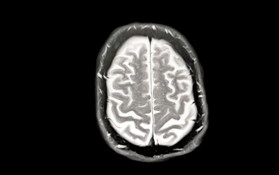 Experts outline key memory symptoms signalling possible dementia