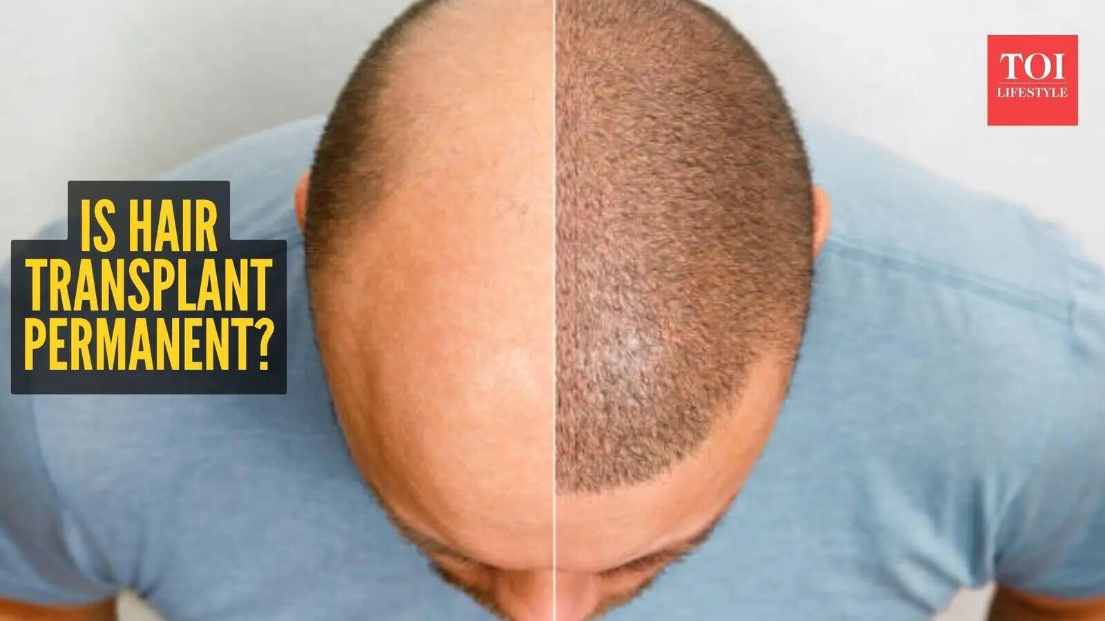 Is hair transplant permanent?
