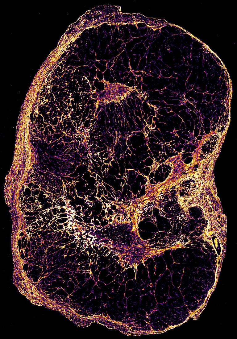 Slow-dividing breast cancer cells may explain relapses decades after ...