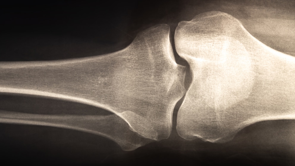 The surprising link between bone health and mental well-being