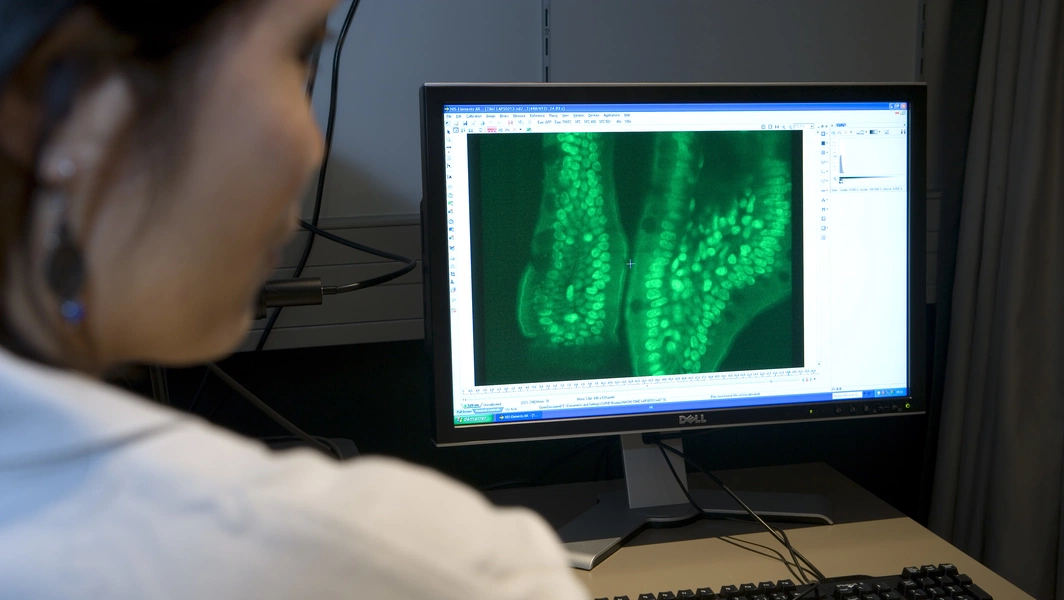 New dietary guidance targets proteinuria in IgA nephropathy, C3G