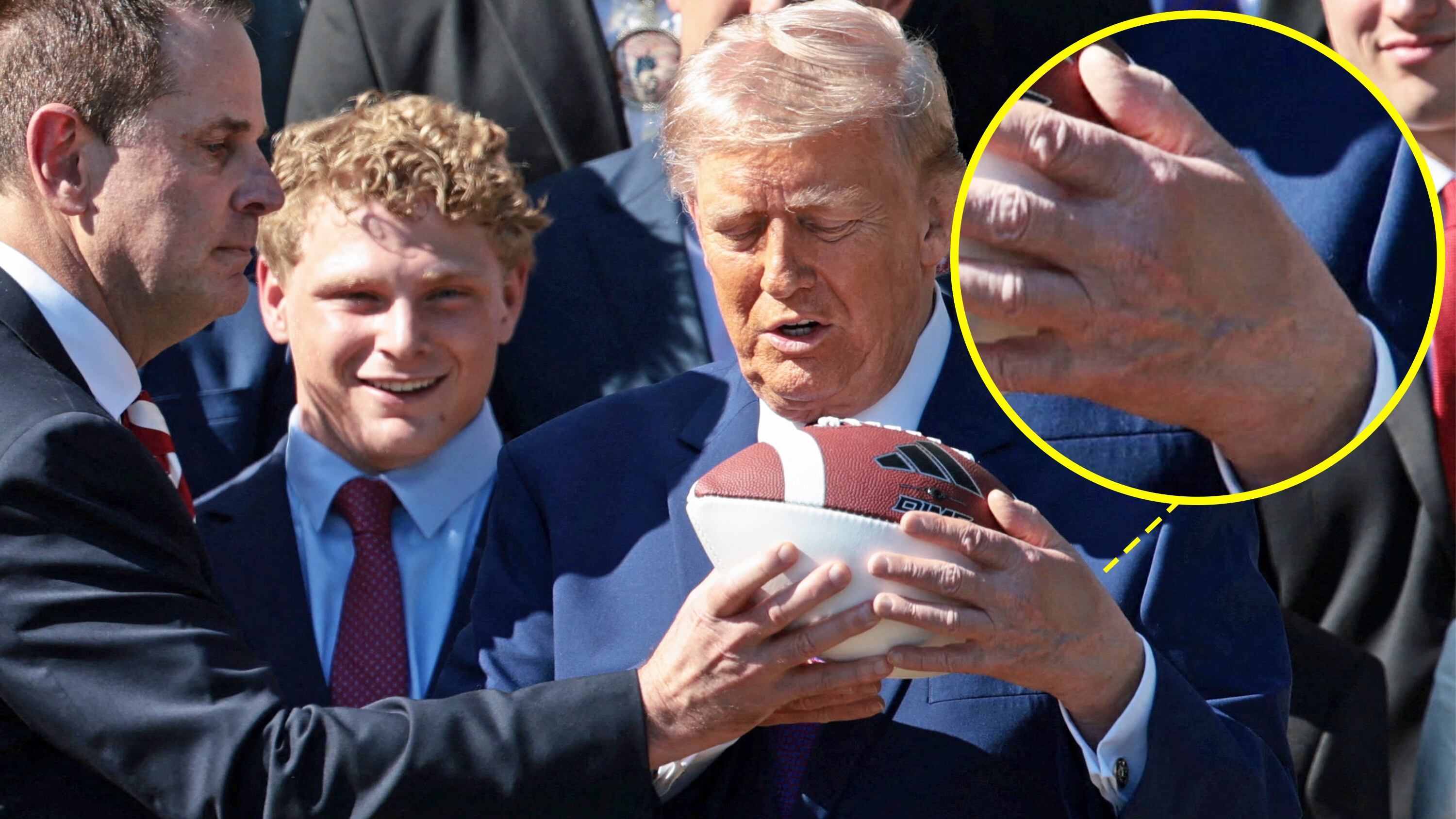 Trump, 79, masks bruising on both hands ahead of his big trip