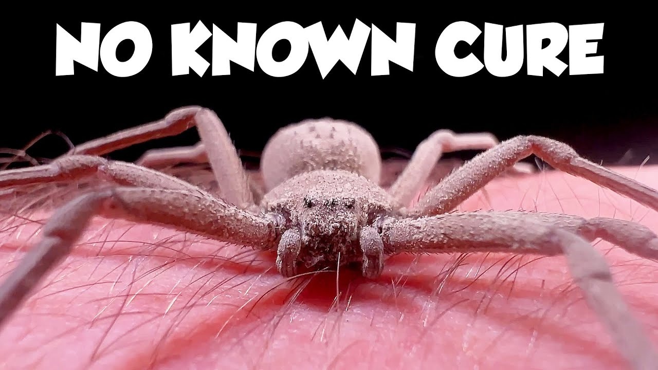 This is the worst spider bite on Earth - and no cure has been found