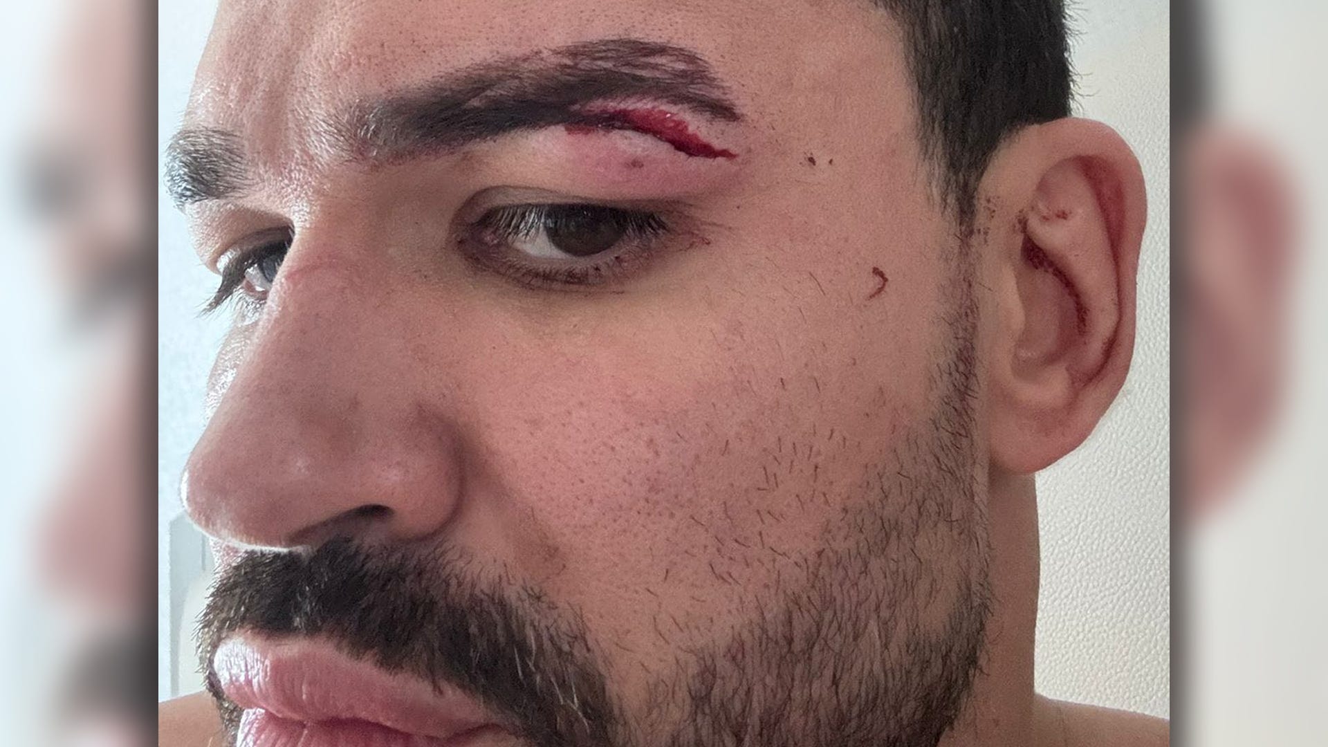 Patricky Freire out of Karate Combat 61 after eye cut during brawl