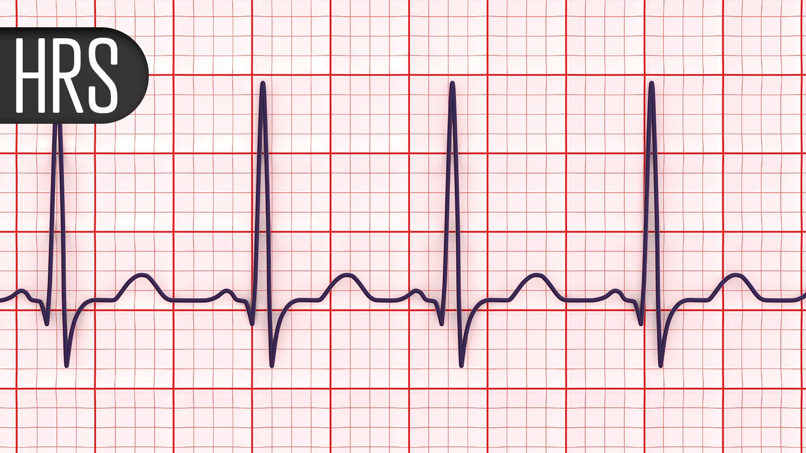 Novel pulsed field ablation system turns to high-energy, ultra-short zaps