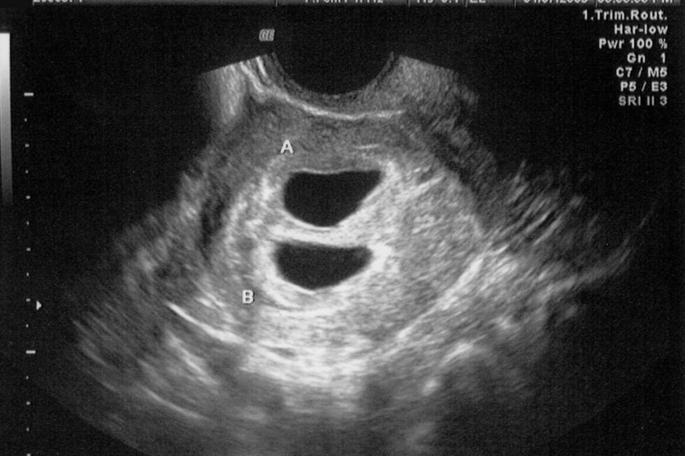 Twins stunned to find they have different dads after home DNA test in ...