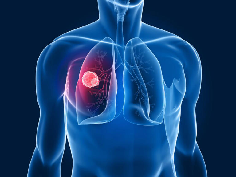 Quali sono i campanelli d’allarme per un tumore?