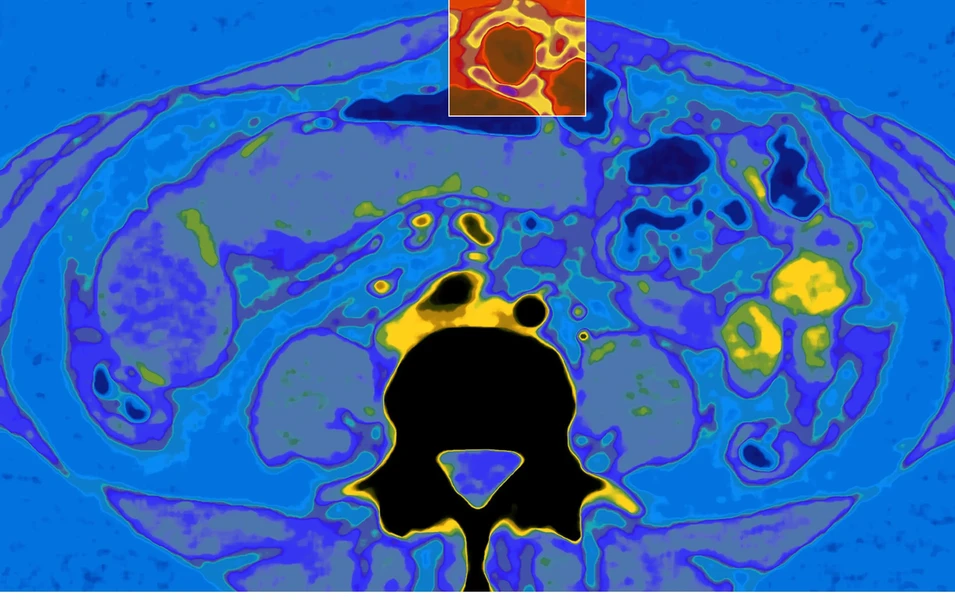 AI model detects stage 0 pancreatic cancer years early