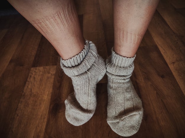 This is when to be concerned if your socks leave marks on your legs