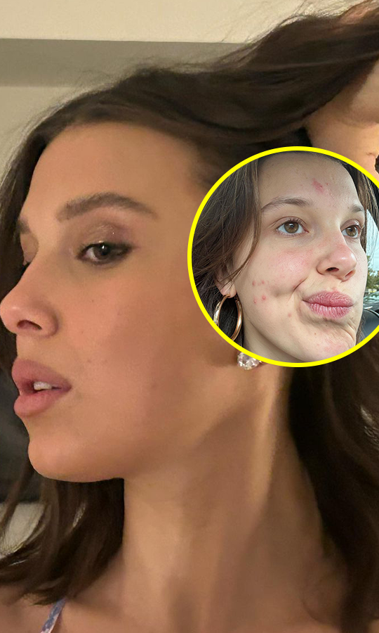 Millie reveals secret acne 💔