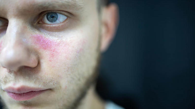 Why did Michael Jackson's skin turn white? The truth about vitiligo and ...
