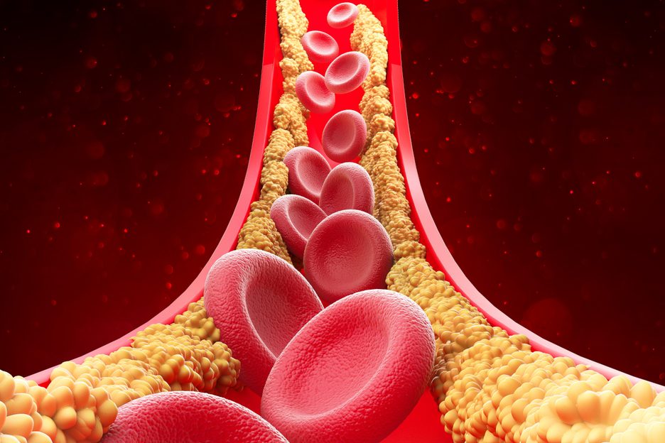 Here's what actually causes high cholesterol (and how to cut it)