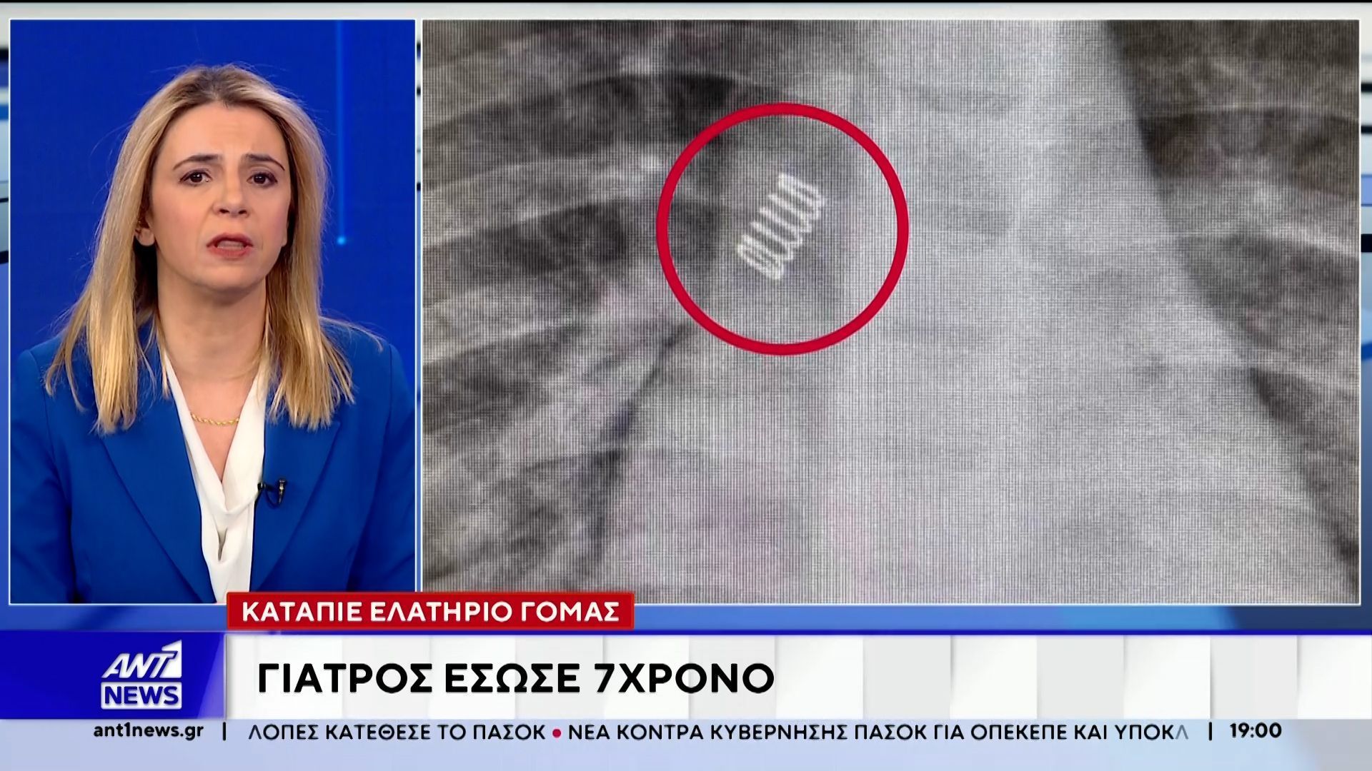Επτάχρονος κατάπιε ελατήριο γομολάστιχας - σώθηκε χάρη σε άμεση ιατρική ...